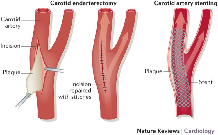 What is Carotid Artery Blockage? Symptoms and Treatment Options - Prof ...