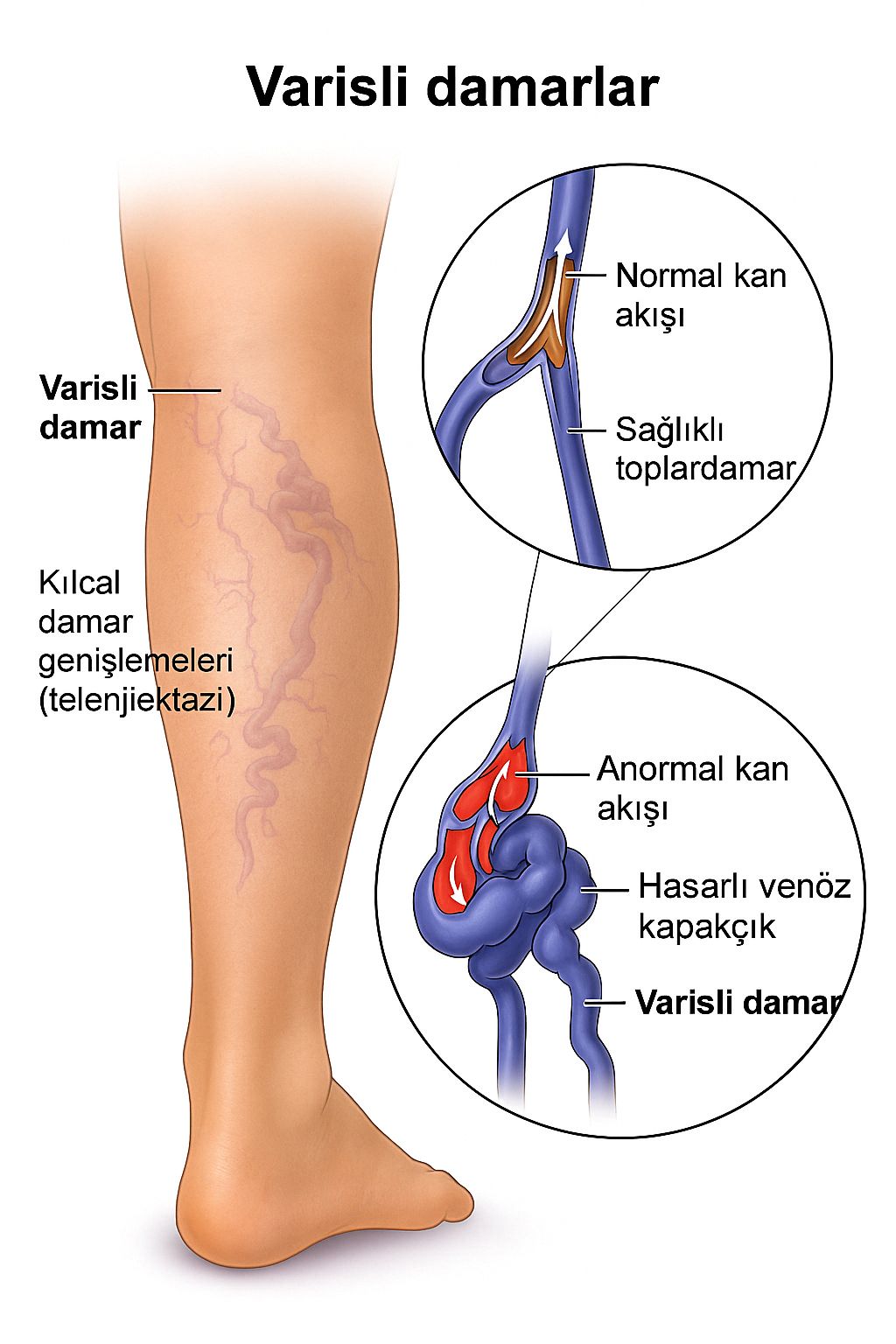 Varis Nedir? Belirtileri, Nedenleri ve Etkili Tedavi Yöntemleri - Prof. Dr. Selim İsbir