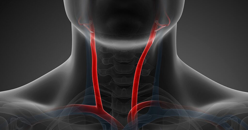 What is Carotid Artery Blockage? Symptoms and Treatment Options - Prof ...